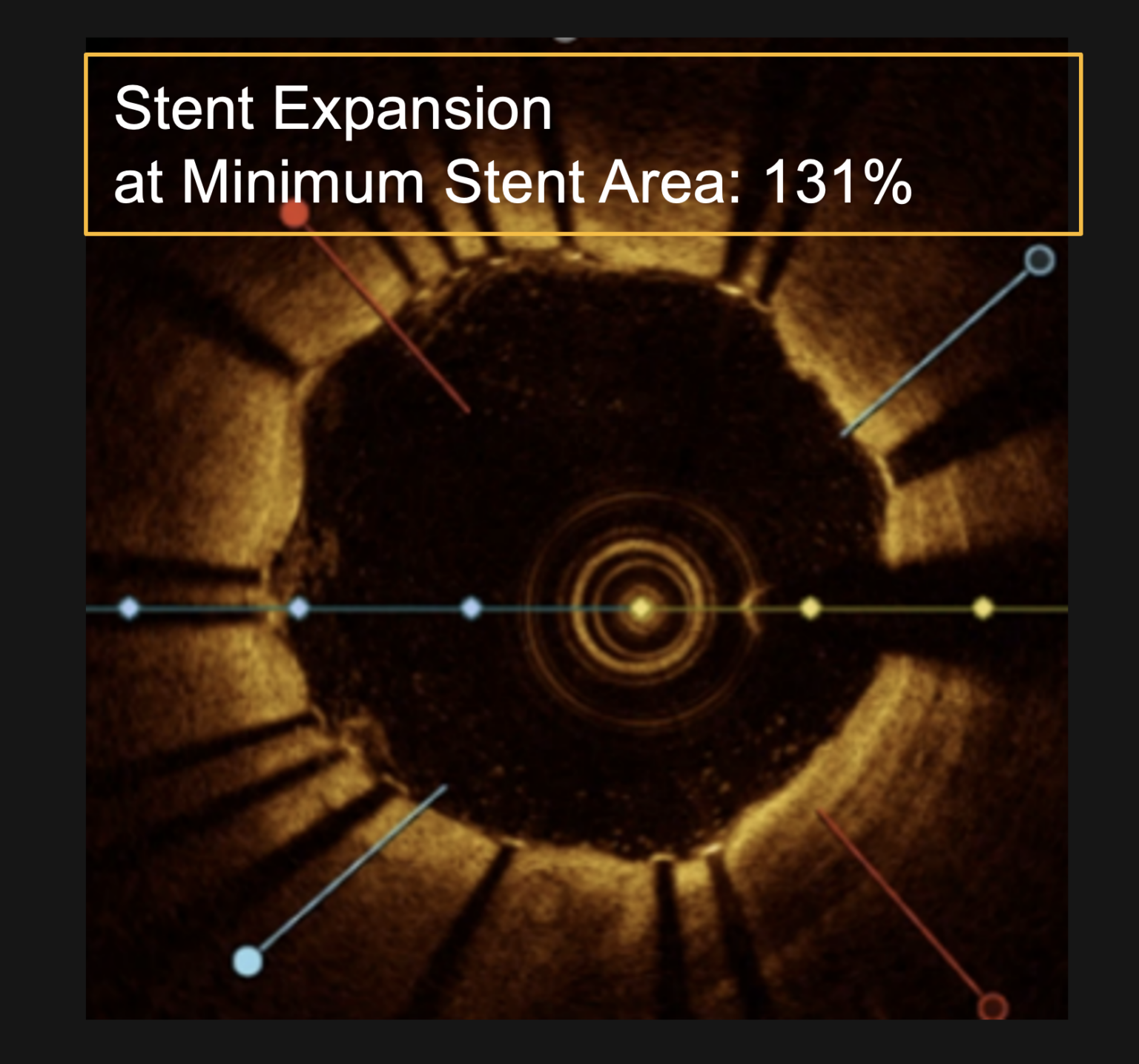 LithiX HC-IVL | Advanced Intravascular Lithotripsy for Calcified ...