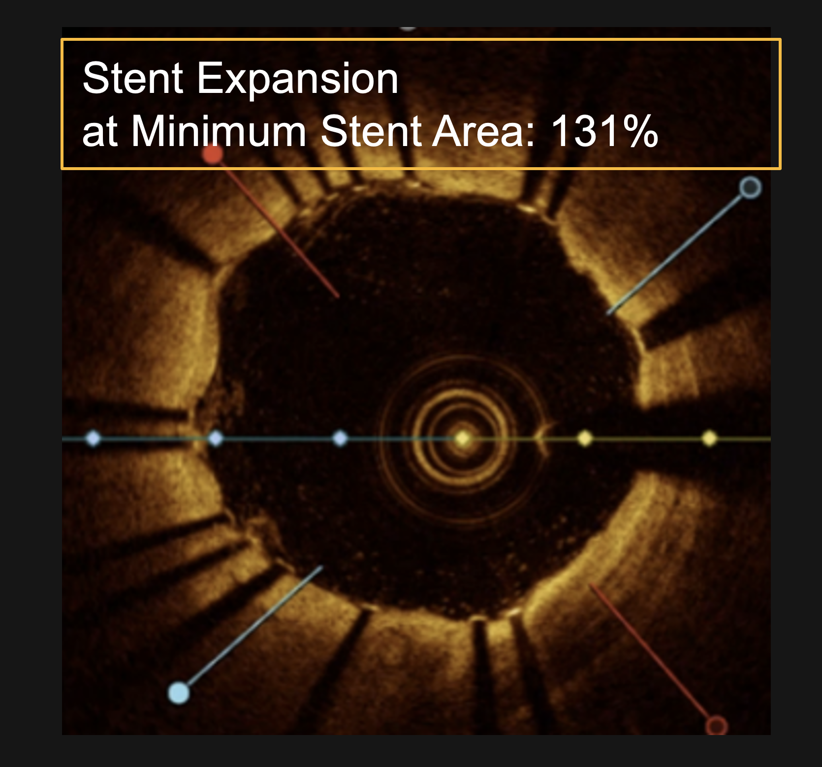 LithiX HC-IVL | Advanced Intravascular Lithotripsy for Calcified ...