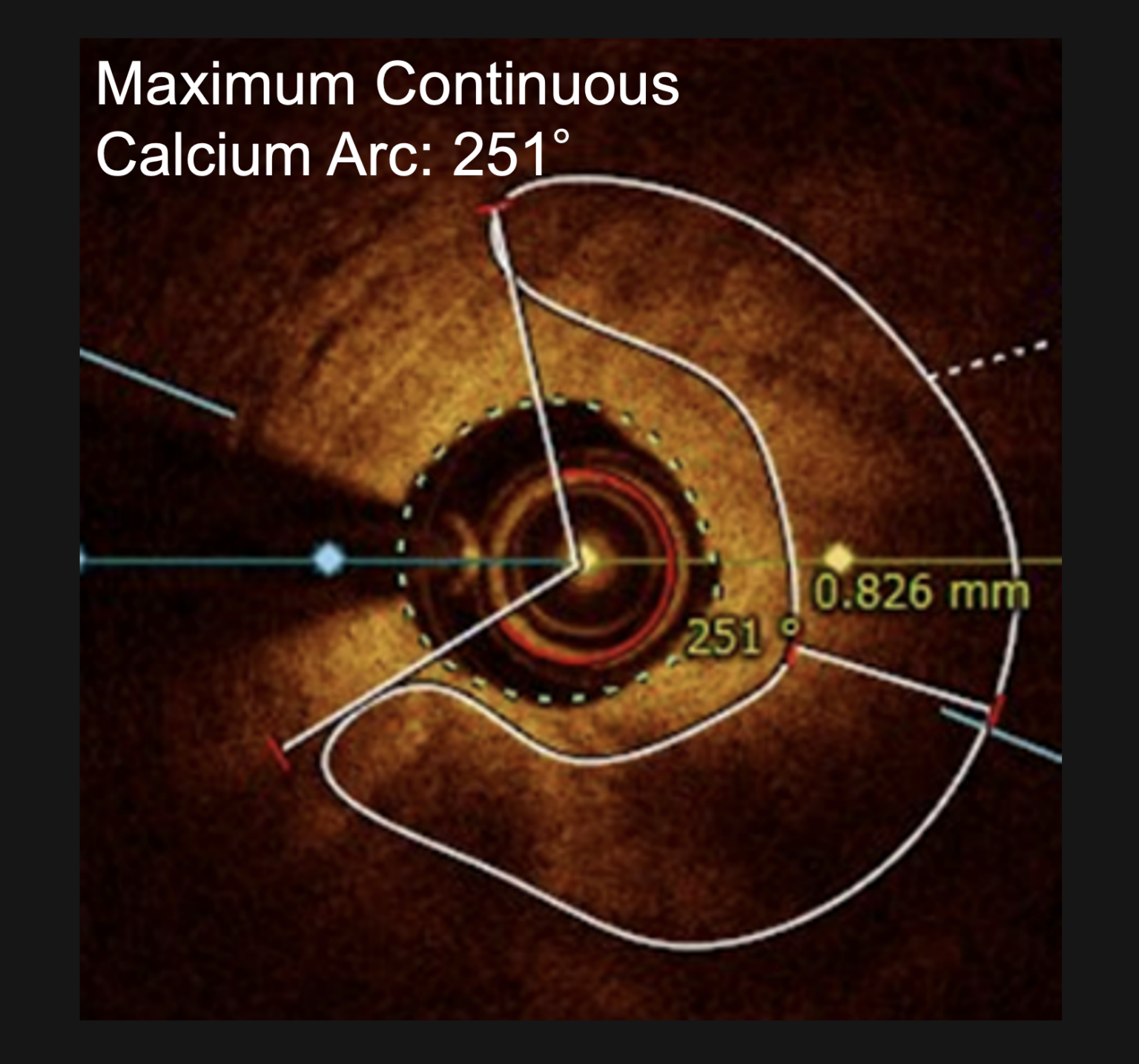 LithiX HC-IVL | Advanced Intravascular Lithotripsy for Calcified ...
