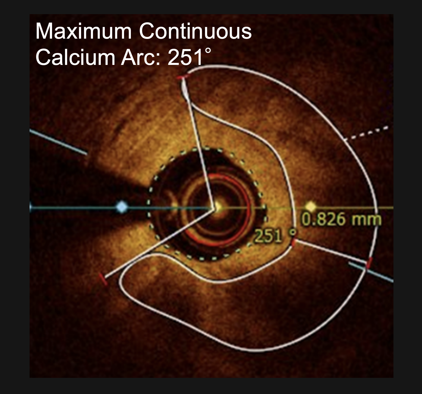 LithiX HC-IVL | Advanced Intravascular Lithotripsy for Calcified ...