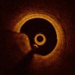 LithiX HC-IVL | Advanced Intravascular Lithotripsy for Calcified ...