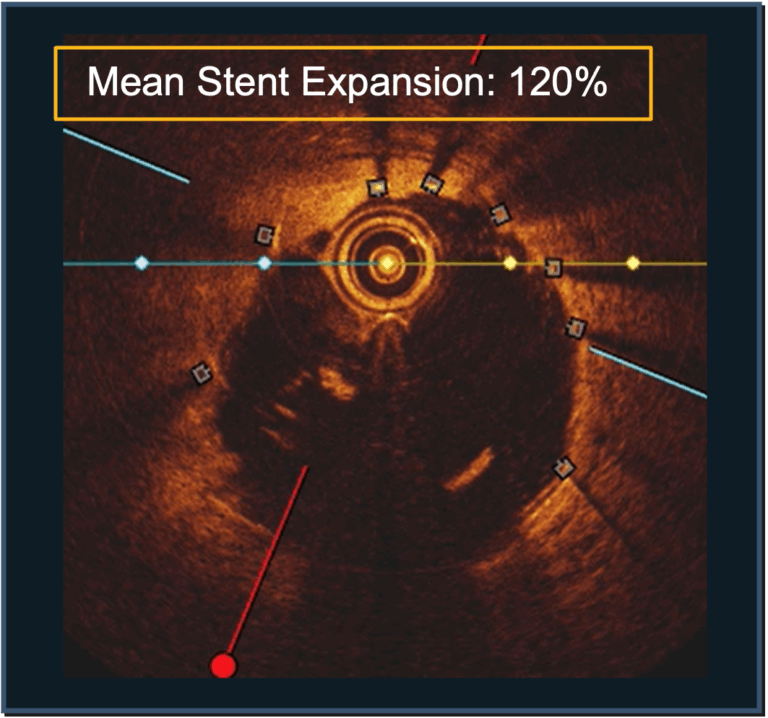 LithiX HC-IVL | Advanced Intravascular Lithotripsy for Calcified ...
