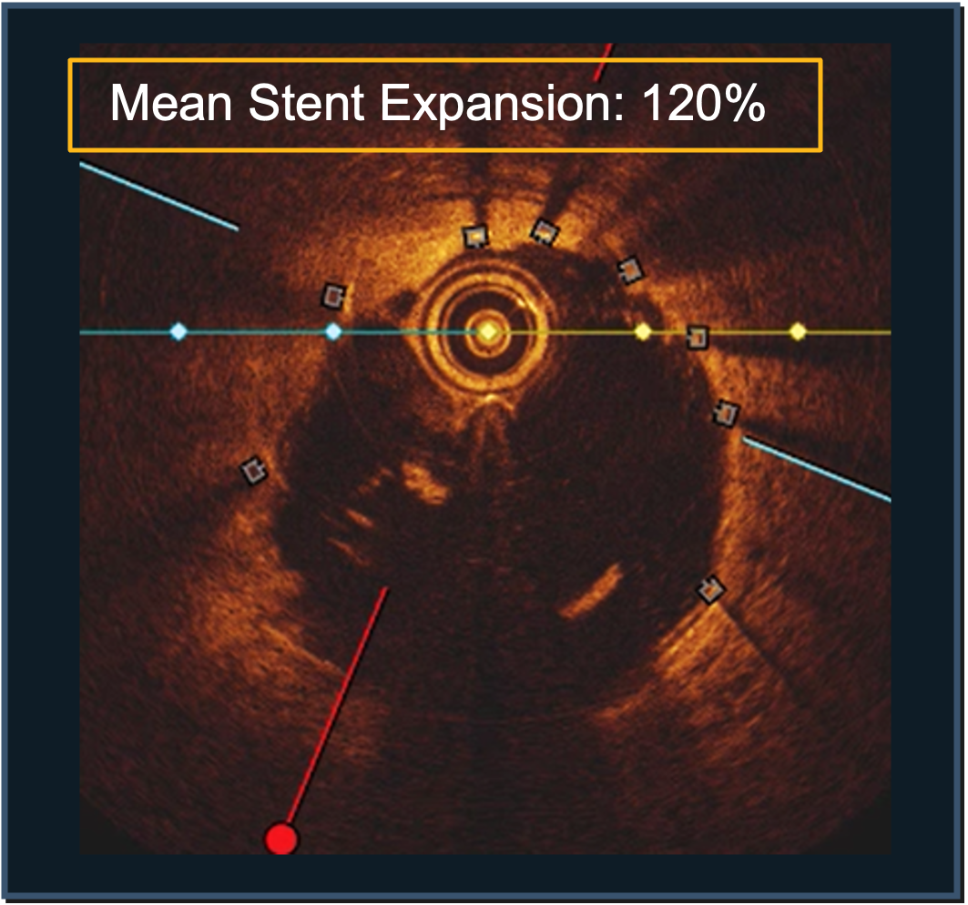 LithiX HC-IVL | Advanced Intravascular Lithotripsy for Calcified ...