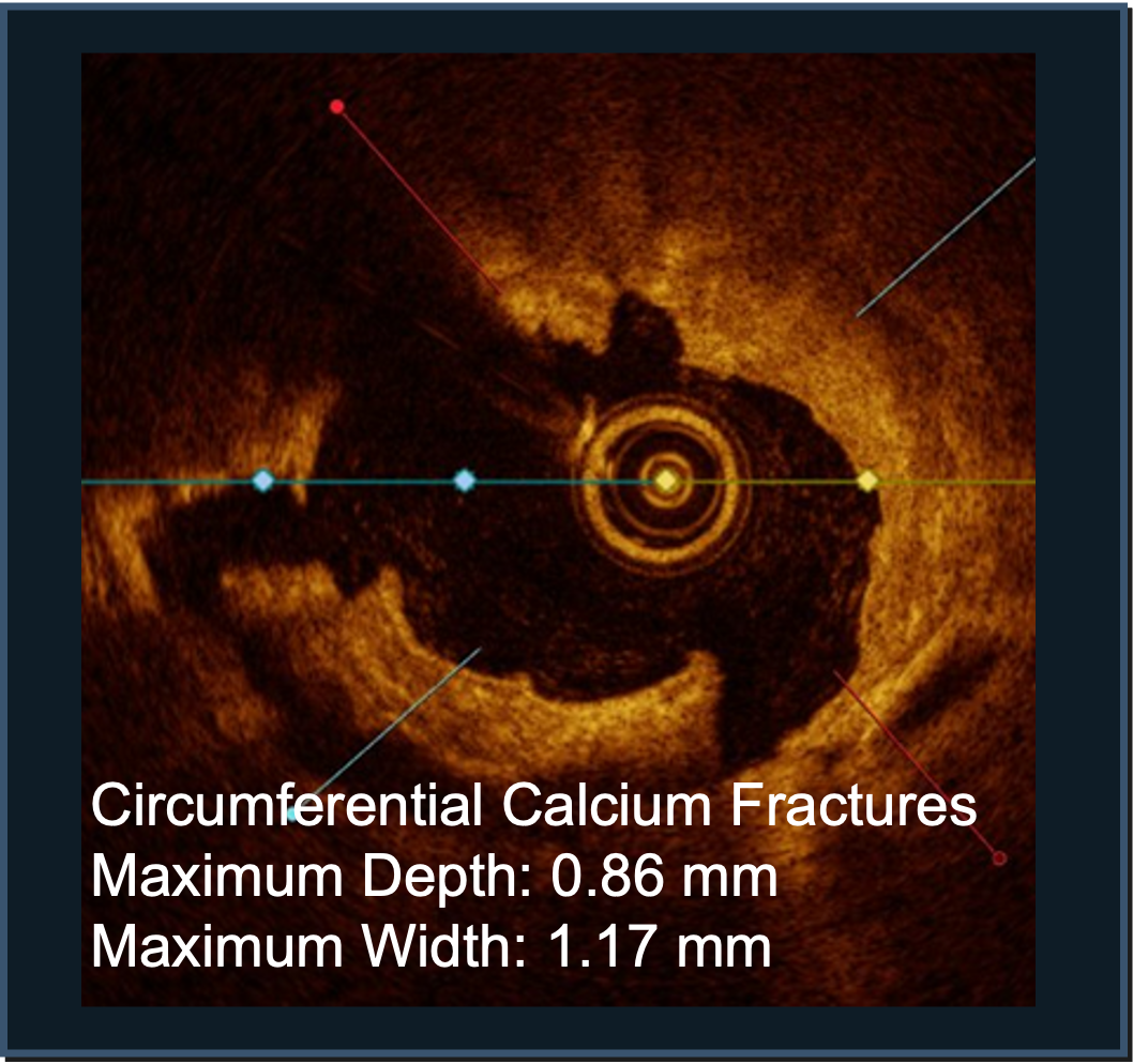 LithiX HC-IVL | Advanced Intravascular Lithotripsy for Calcified ...