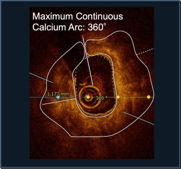 LithiX HC-IVL | Advanced Intravascular Lithotripsy for Calcified ...