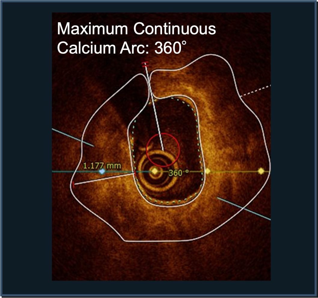 LithiX HC-IVL | Advanced Intravascular Lithotripsy for Calcified ...