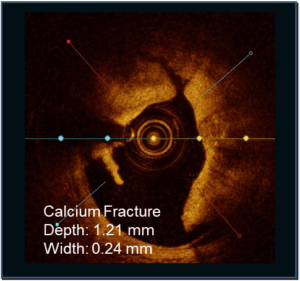 LithiX HC-IVL | Advanced Intravascular Lithotripsy for Calcified ...