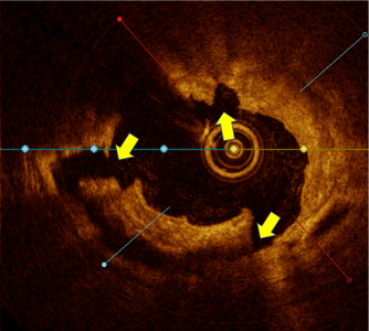 Clinical Evidence — Elixir Medical - Elixir Medical